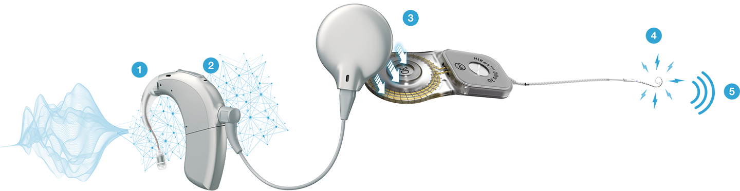 Como funcionam os implantes cocleares | Advanced Bionics
