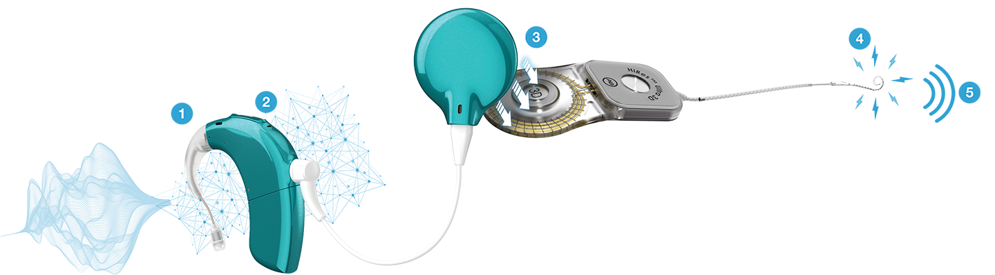 How Cochlear Implants Work For Kids | Advanced Bionics