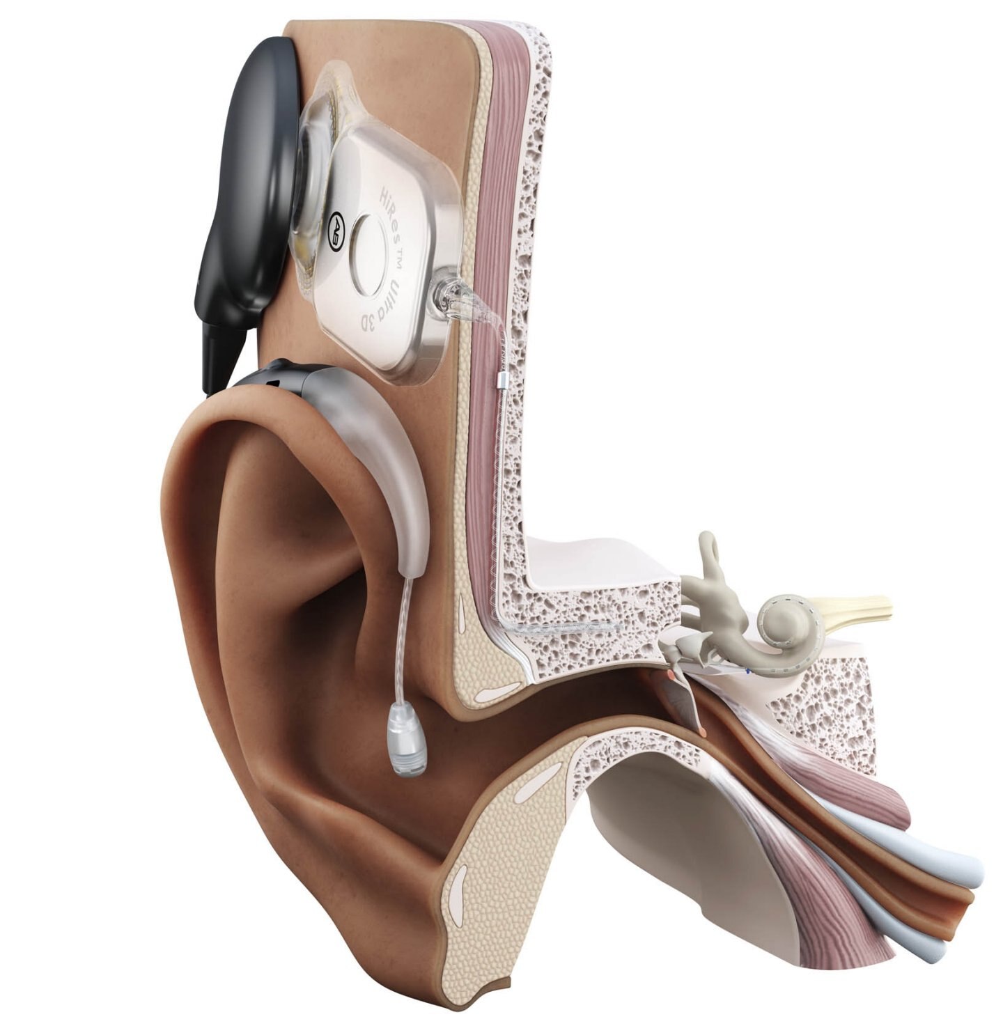 Understanding The Cochlear Implant Process From Evaluation To Candidacy Advanced Bionics