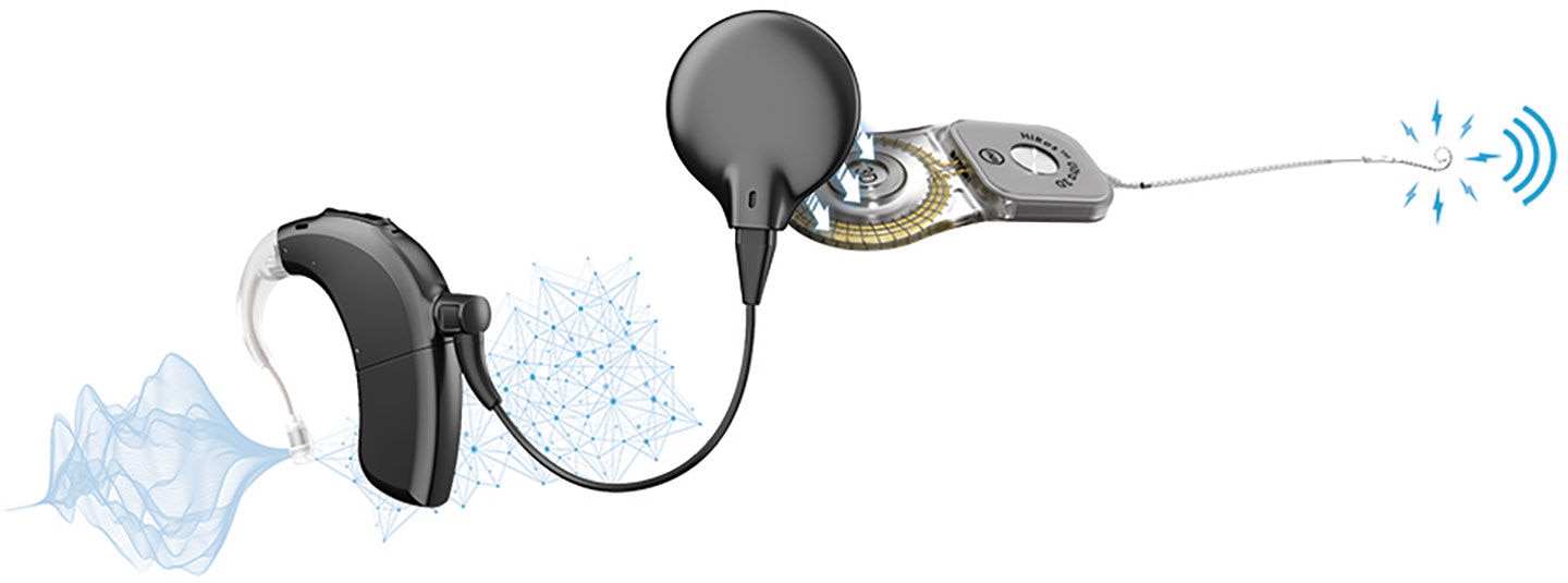 Cochlear Implants For Adults | Advanced Bionics