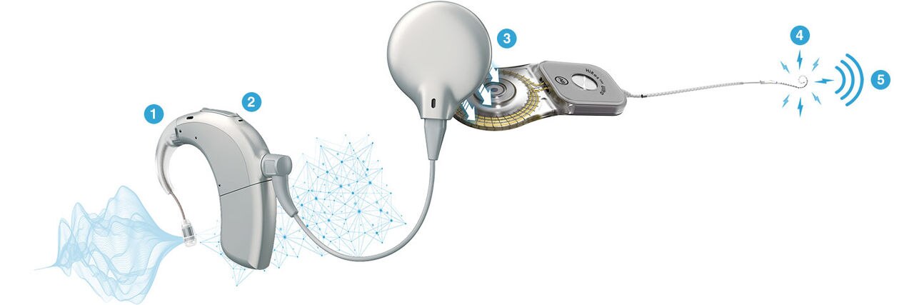 home | Advanced Bionics