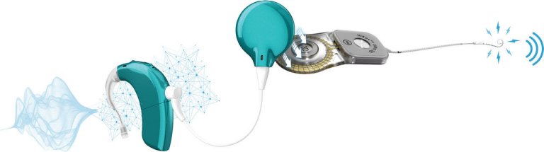 The History and Future of Cochlear Implants - Spahr | Advanced Bionics