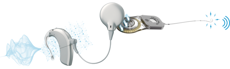 How to Determine the Cost of a Cochlear Implant for You - Wyatt ...