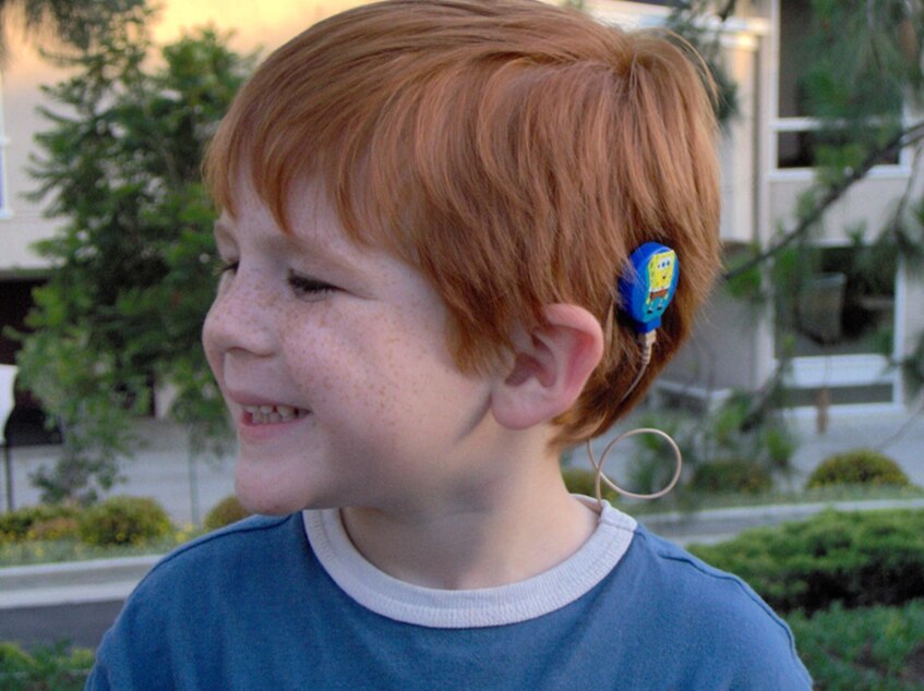 Matthew’s Journey with Cochlear Implant Revision Surgery | Advanced Bionics