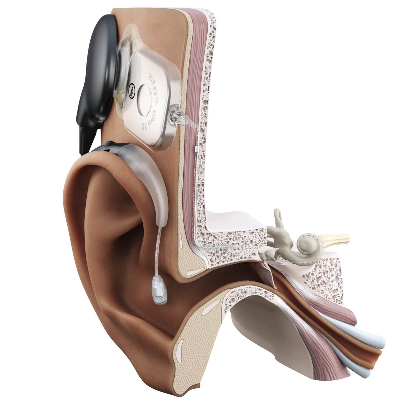 Understanding the Cochlear Implant Process: From Evaluation to Candidacy | Advanced Bionics