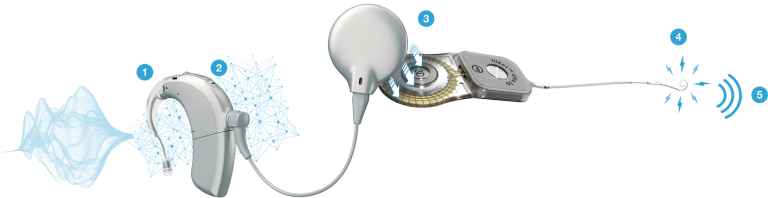 Marvel CI | Naída CI Marvel Cochlear Implant System for Adults ...