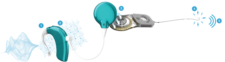 How Do Cochlear Implants Work For Kids | Advanced Bionics